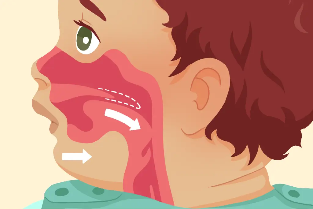 Information booklet on the Pierre Robin sequence • Cassandra Vion ...